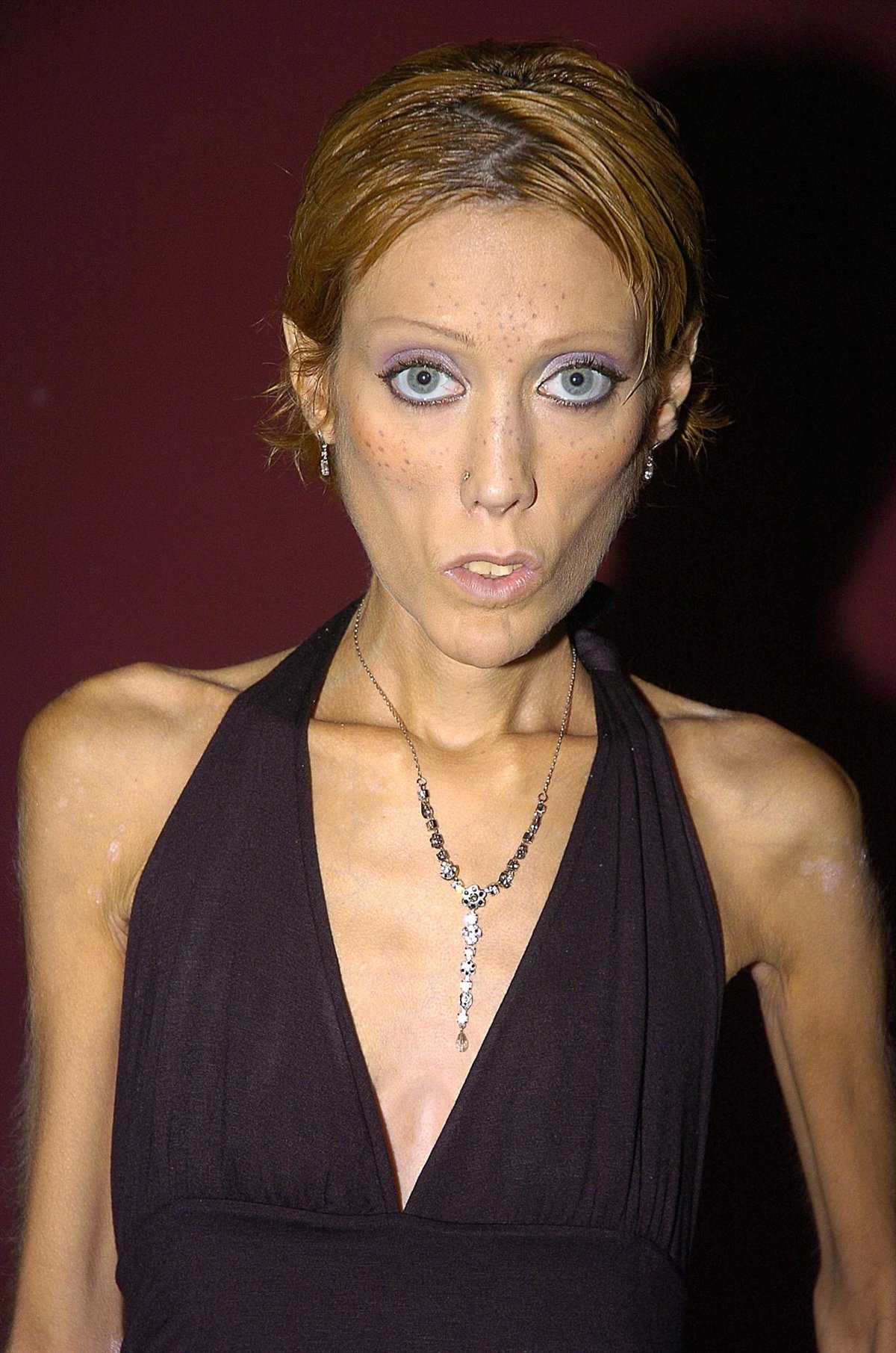 Blog de Josep Lluesma: Isabelle Caro. Anorexia nerviosa.