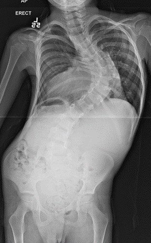 Halo-Gravity Traction in Spinal Deformity Treatment (Part 2) | Growing ...