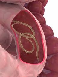 Enfermedades : Ascariasis