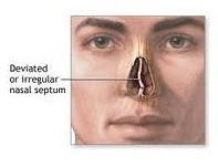 ENT for you and me: Septum Deviasi