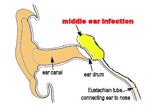 Dr. Sandy: Mom First, Pediatrician Second: Ear Infections – What Are ...