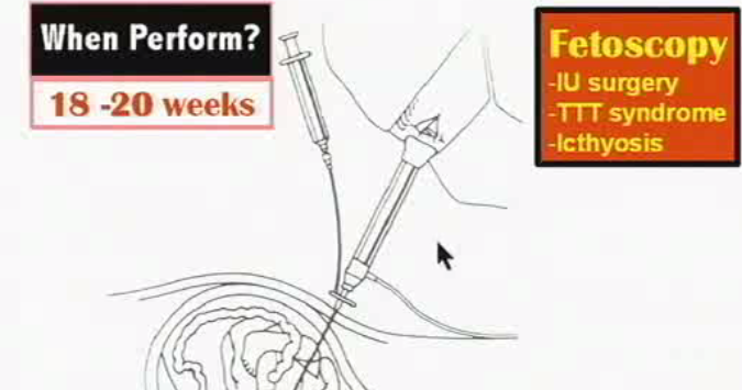 MBBS Medicine (Humanity First): Fetoscopy