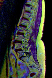 Nevit's blog: Color MRI of spine