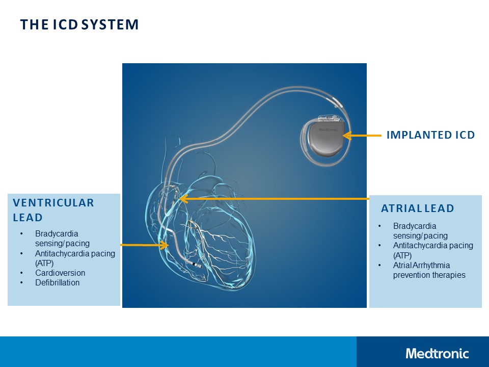 CVT Mohd Farid: Concept Of ICD Technology-Sensing & Detection-Medtronic ...