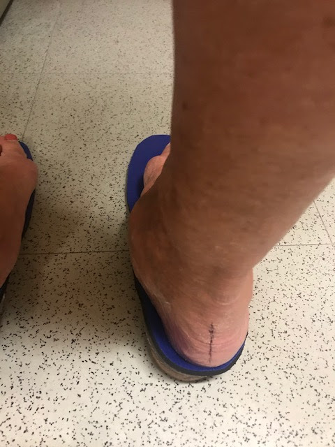 Foot and Ankle Problems By Dr. Richard Blake: Assessing Correction with ...