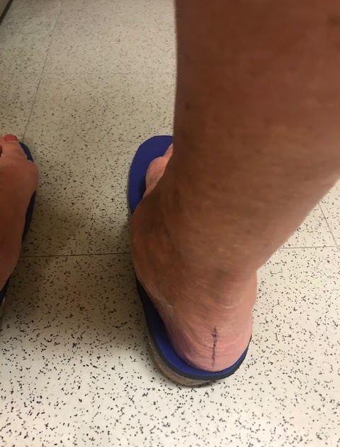 Foot and Ankle Problems By Dr. Richard Blake: Assessing Correction with ...