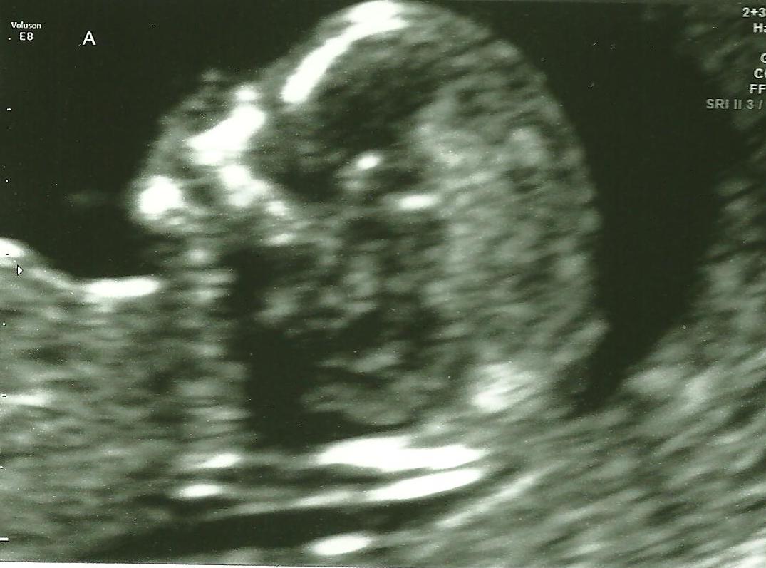 2 New Rubys: 14 week ultrasound pictures