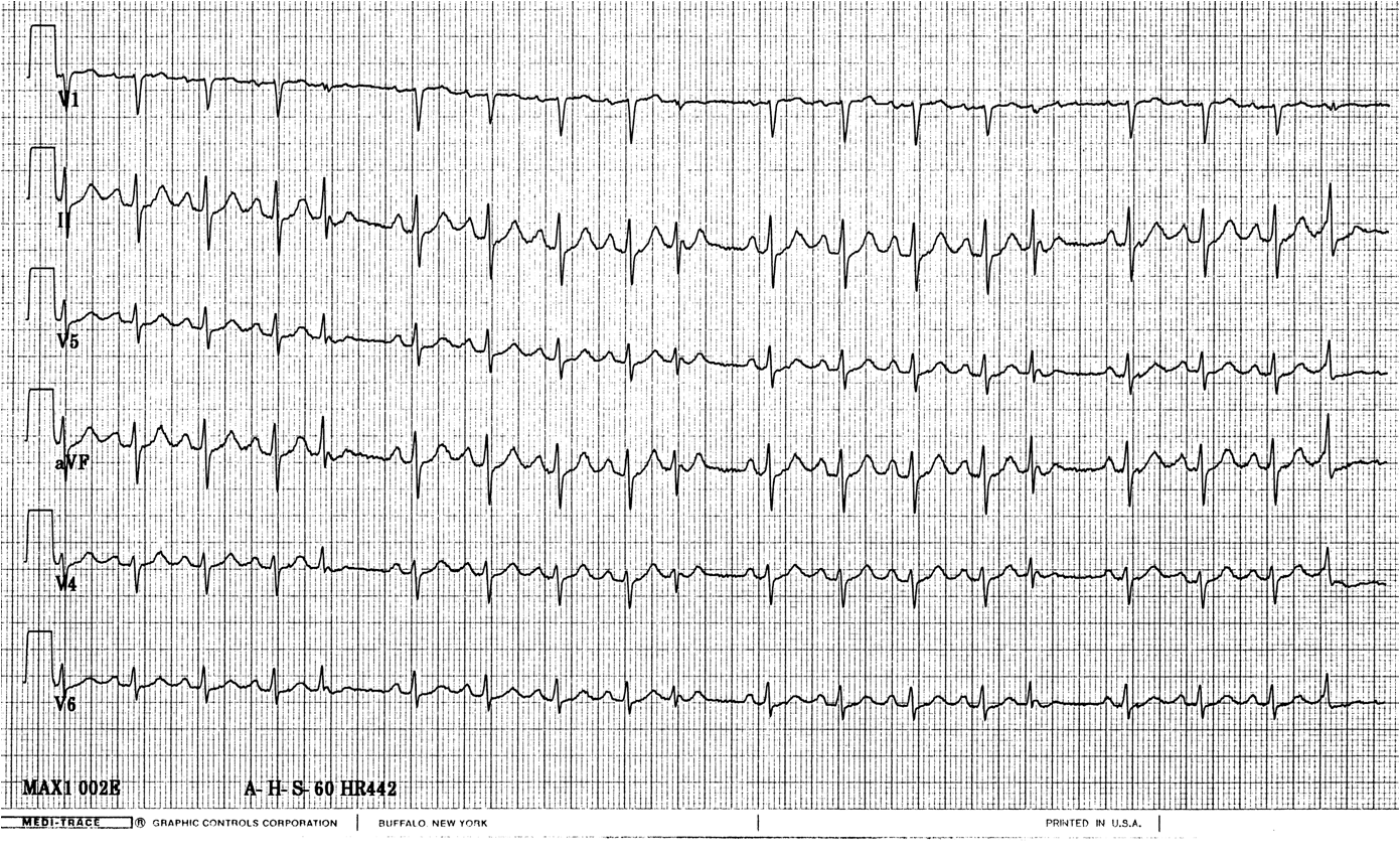 Dr. Smith's ECG Blog: Pseudo Type II Second Degree AV Block Induced by ...