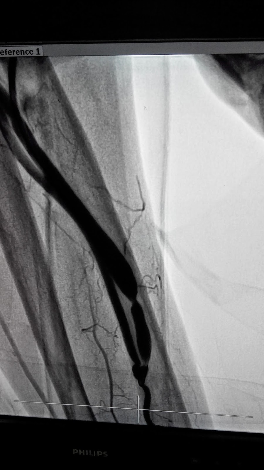 RUANG PRAKTEK BEDAH - DOKTER RAMZI SPB (K) V: Stenosis drain vein av ...