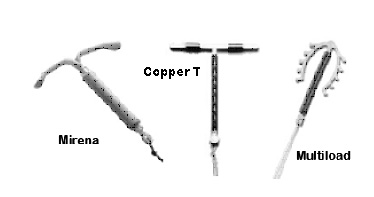 Blog Học Tập-Giải Trí cho sinh viên Y Khoa: Dụng cụ Tử cung tránh thai