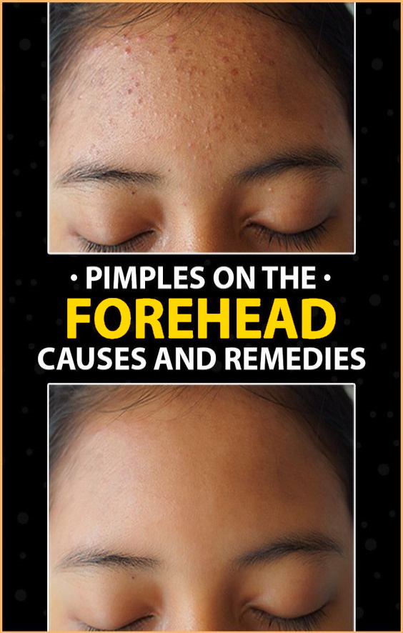 How To Get Rid Of Forehead Acne And Prevention Tips - Healthy Lifestyle