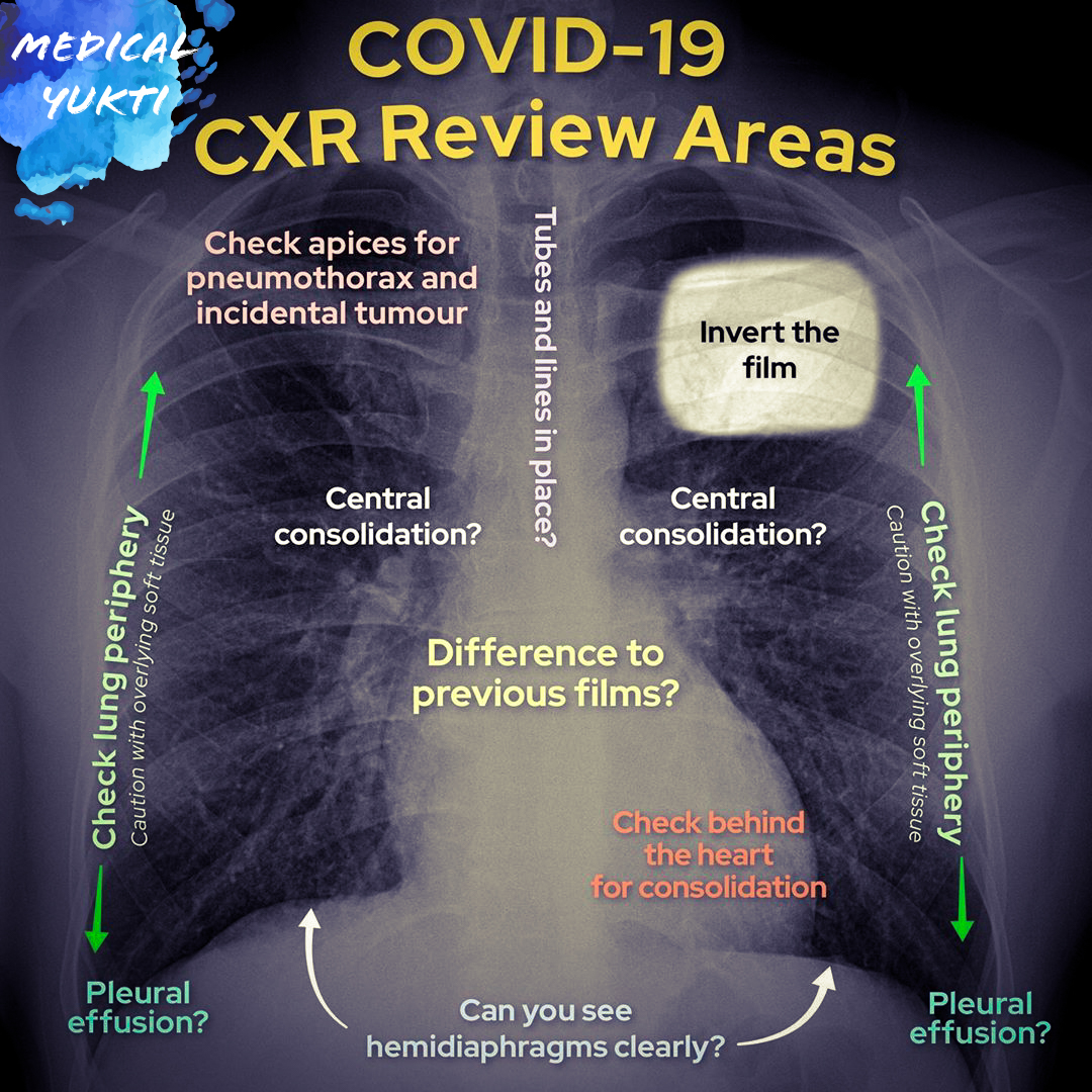 COVID-19 (Let’s look at what we should be looking for on CXR) - Medical ...