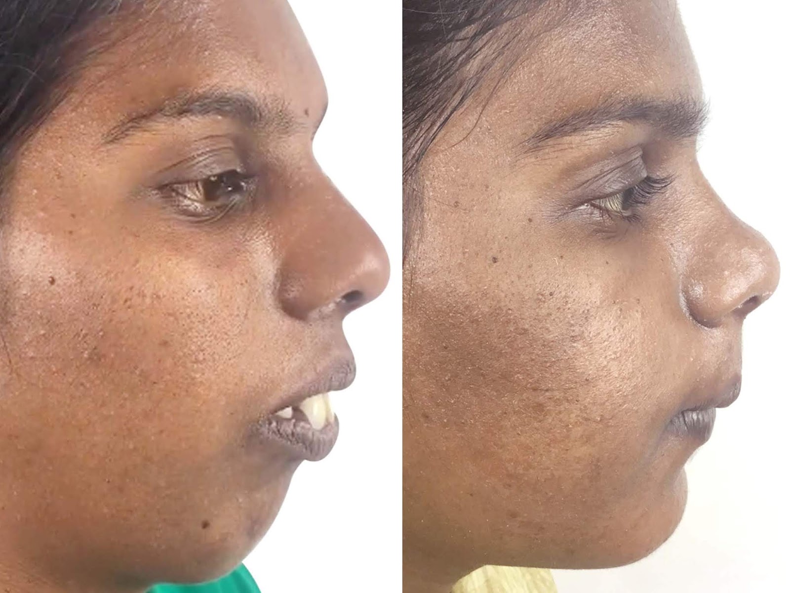 CHIN AUGMENTATION - Richardson dental and craniofacial Hospitalposts