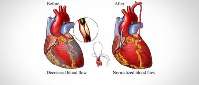 Heart Bypass Surgery: What Is Heart Bypass Surgery?