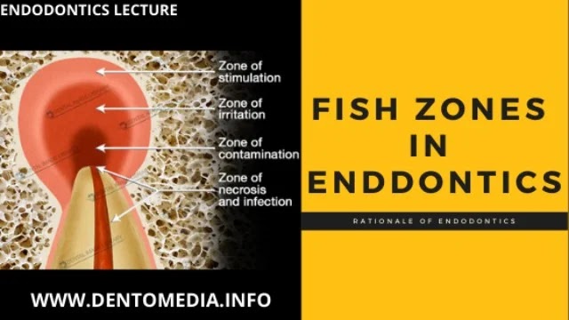 Fish Zones in Endodontics