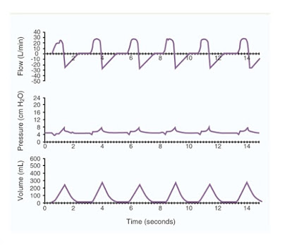 Nursing: SETTINGS, MODES & ALARMS OF MECHANICAL VENTILATOR