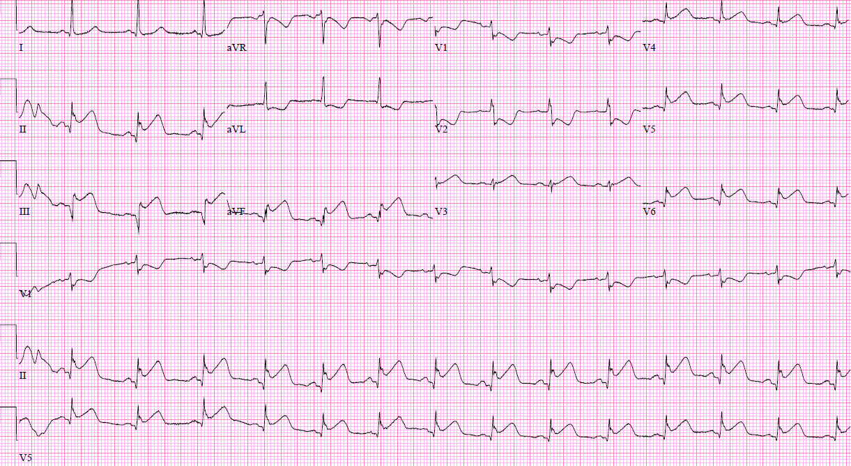 Medicowesome: Coronary artery dominance and EKG changes