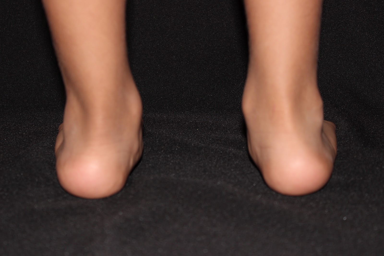 Ortopedia Pediátrica para Padres de Familia: Pie plano en niños