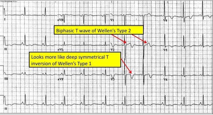 Emergency Medicine Blog: Advanced ECG by Amal Mattu in Singapore