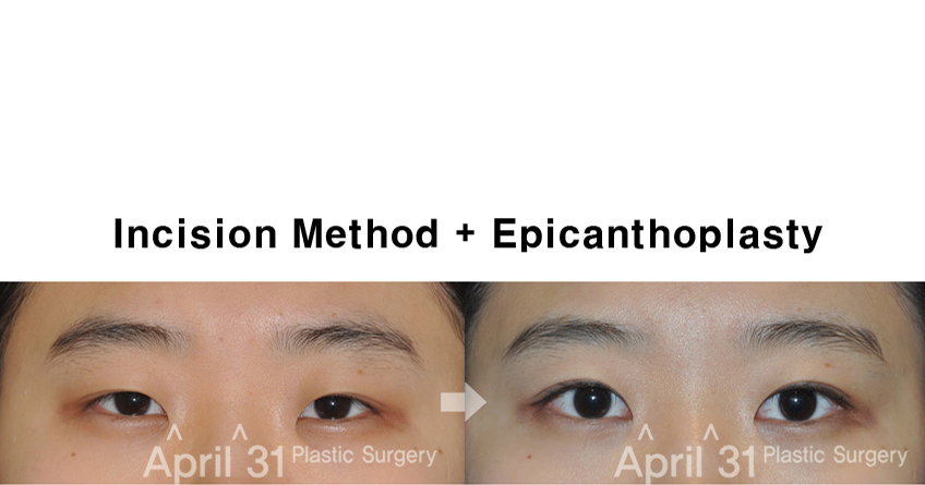 April31 Plastic Surgery Clinic: Incision Method + Epicanthoplasty