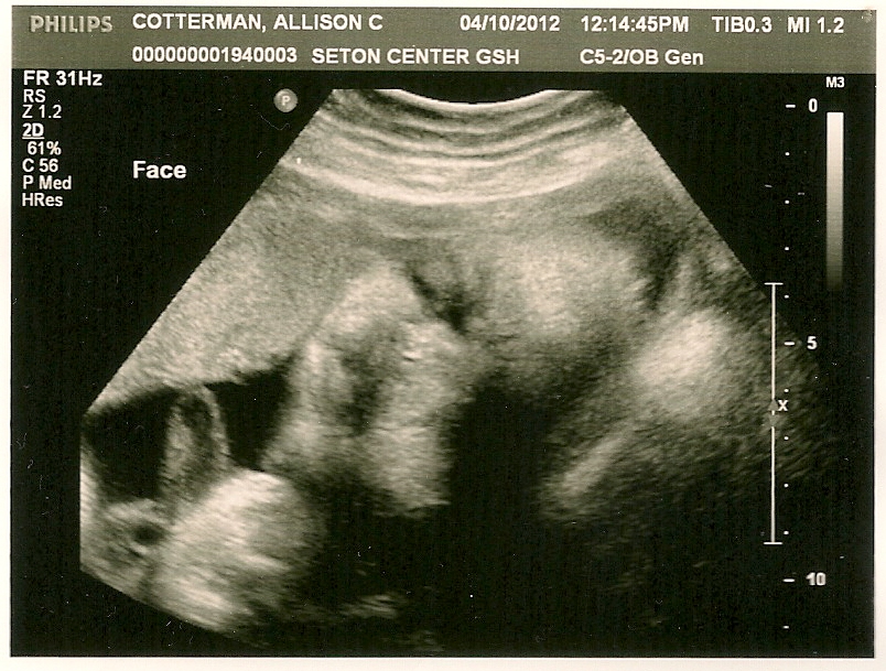William Jude: 33 week ultrasound