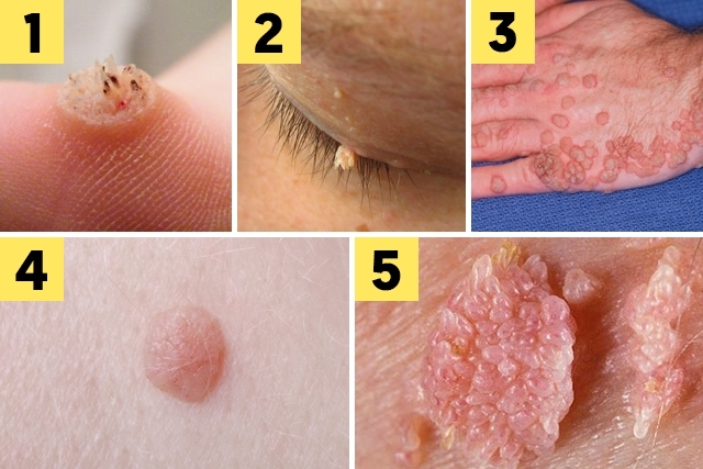 Espaço Franceline Maraia - Clinica MicroDermo: Remoção de verruga