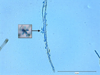 Fun With Microbiology (What's Buggin' You?): Fonsecaea pedrosoi/monophora