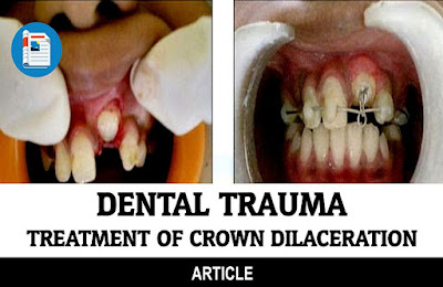 DENTAL TRAUMA: Treatment of Crown Dilaceration: An interdisciplinary ...