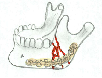 MCQ's in Facial Plastic & Reconstructive Surgery: 1231-1240 MCQ in ...