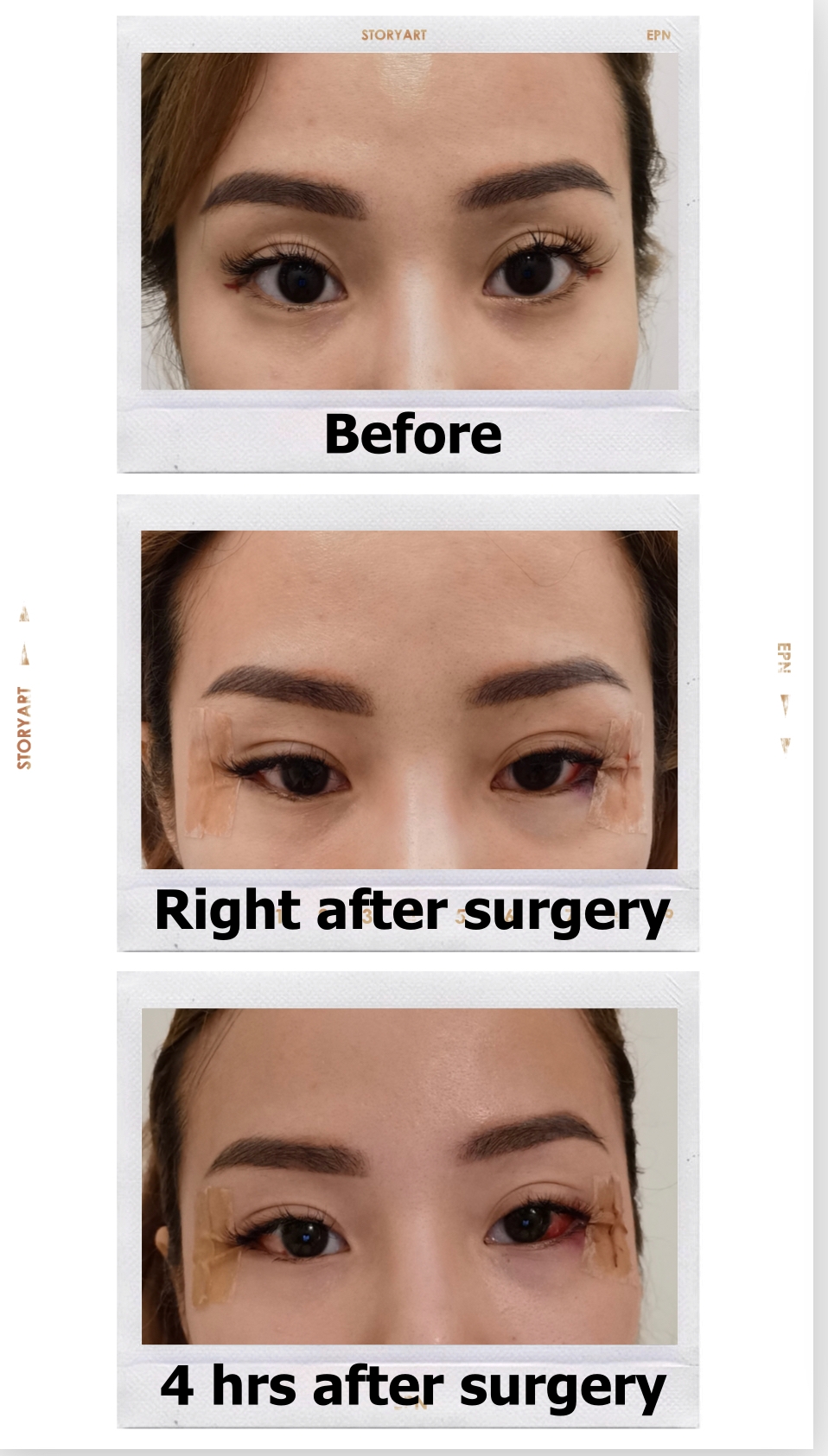 Medial Epicanthoplasty Before And After