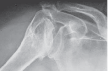 UW Shoulder and Elbow Academy: Humeral head osteotomy in shoulder ...