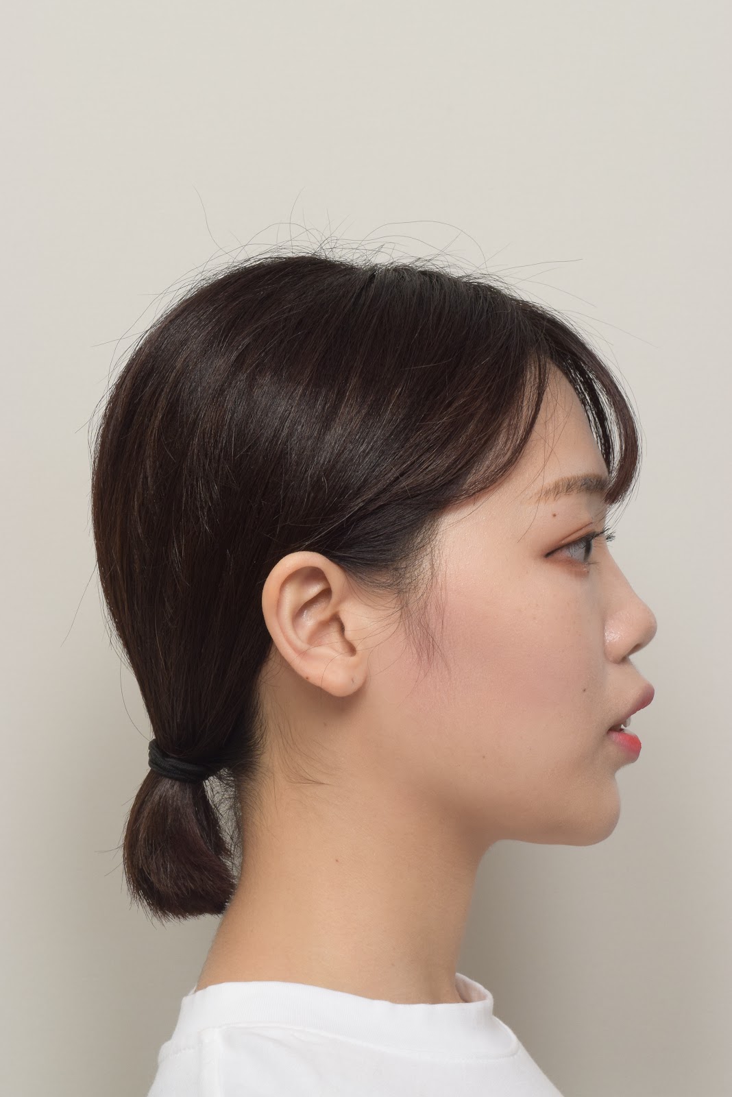 Anterior Segmental Osteotomy (ASO) Surgery _ EU