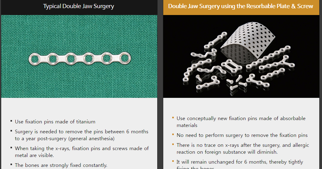 What is Double Jaw Surgery using the Absorbable Plate & Screw? (jaw ...