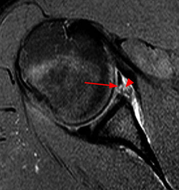 MRI Musculo-Skeletal Section: Labrum