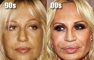 Donatella Versace Surgery