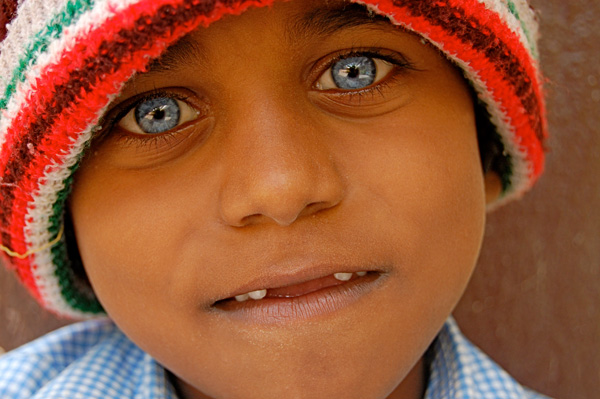 Deformutilation: Blue eyes in India