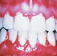 Dra Daniella De Leon: GENGIVITE ULCERATIVA NECROSANTE AGUDA (GUNA)