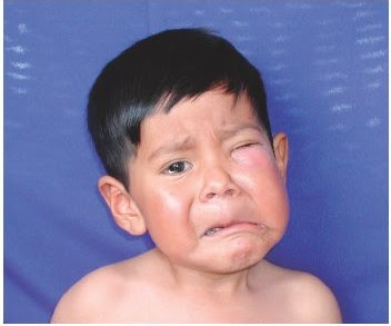 Afecciones En Los Niños: Absceso en los niños. Causas y tratamientos