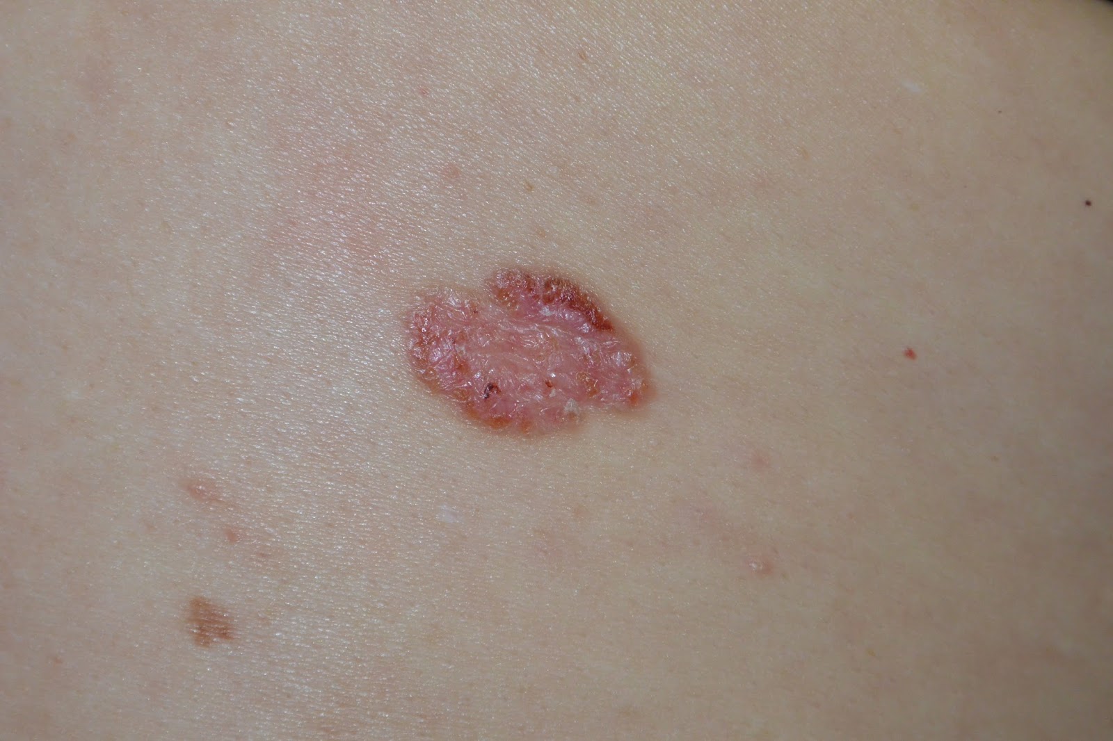 Derma-Docència Castelló: Placa rosada en paciente con psoriasis...