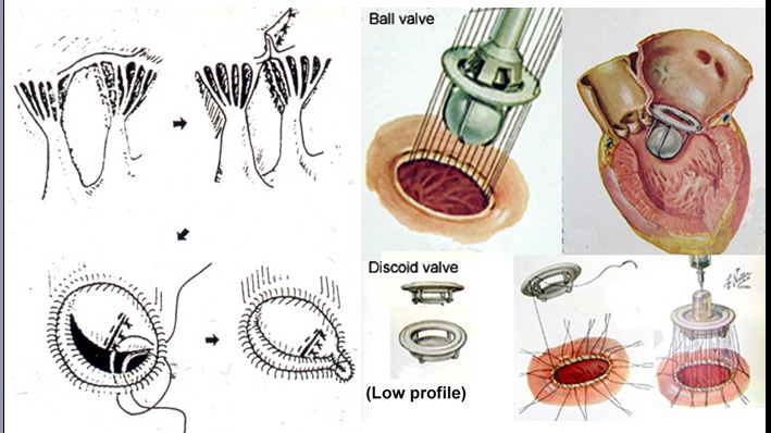 PUBLIC HEALTH: VALVE DISEASE