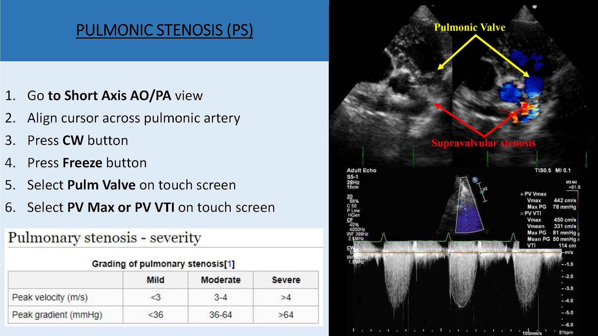 CVT Mohd Farid: Basic Echo Measurements And Values Nurain Jurnalis CVS ...