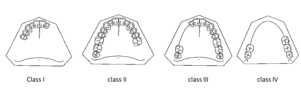 Kennedy classification RPD l Removable partial denture MCQs - WikiDentia