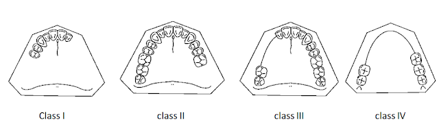 Kennedy classification RPD l Removable partial denture MCQs - WikiDentia