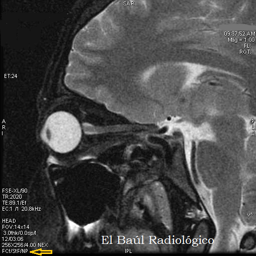 El Baúl Radiológico: ARTEFACTOS POR SUPERPOSICIÓN EN EL SENTIDO DE LA ...