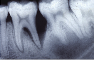CLASSIFICATION OF ALVEOLAR BONE DEFECTS
