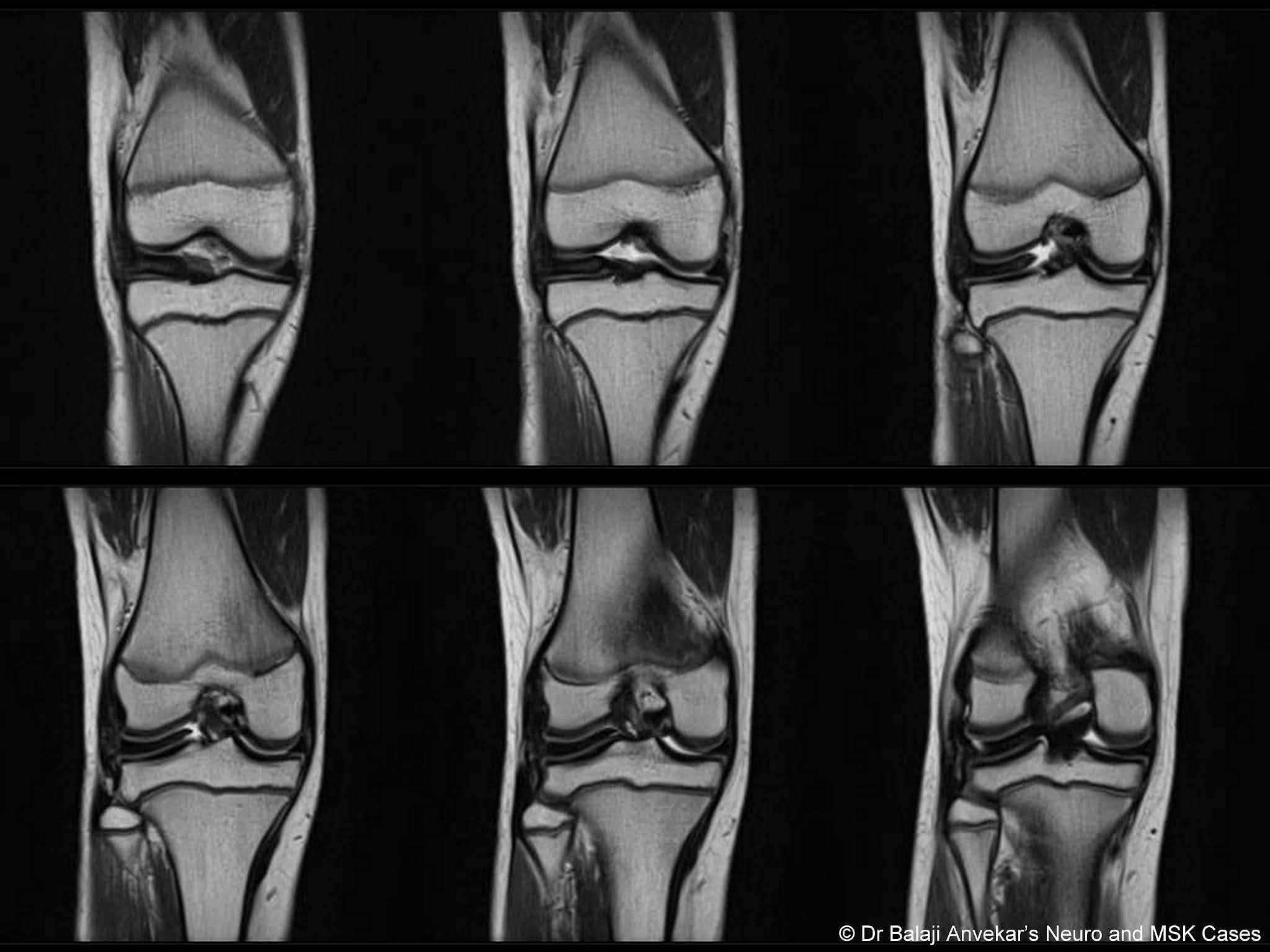 Dr Balaji Anvekar FRCR: Discoid Meniscus