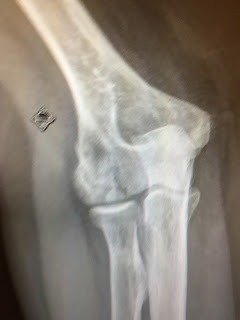 Shoulder and Elbow Surgery: Shear fractures of the capitellum.