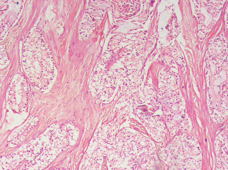into the roots: Mimickers of prostate carcinoma