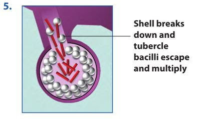 Tuberculosis (TB): Mechanism