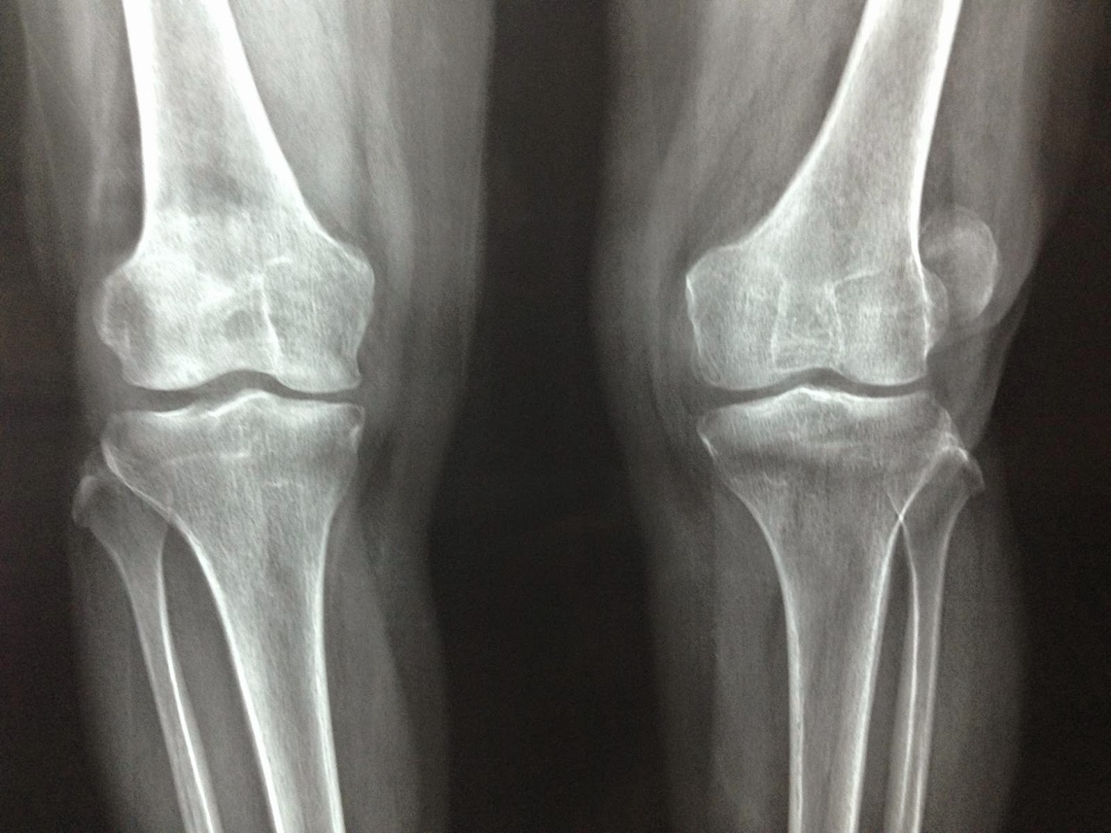 VIETNAMESE MEDIC ULTRASOUND: CASE 308: PATELLA DISLOCATION, Dr PHAN ...